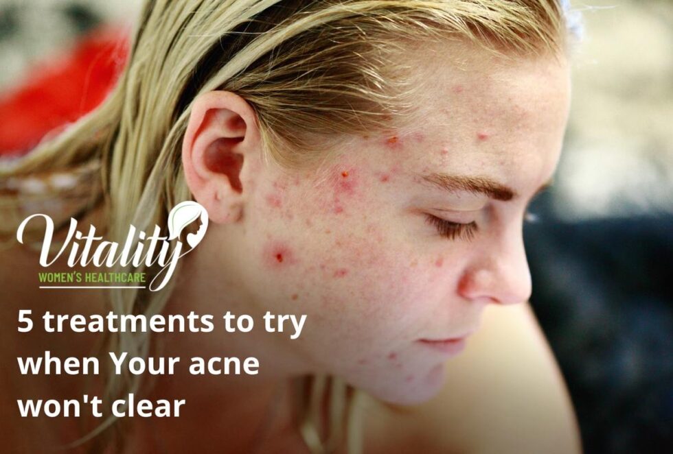 5 Amazing Treatments To Try When Your Acne Won't Clear